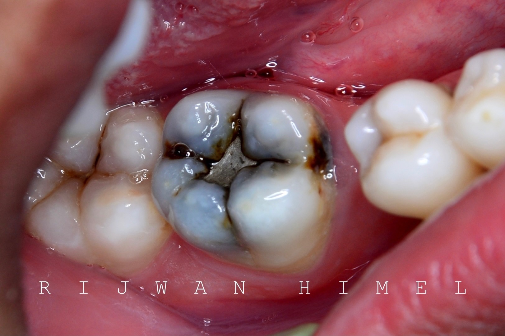 Deep Cavity Biomimic Filling – Tooth Fairy